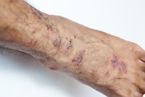 Venous Stasis Dermatitis Lima, OH | Venous Eczema Celina